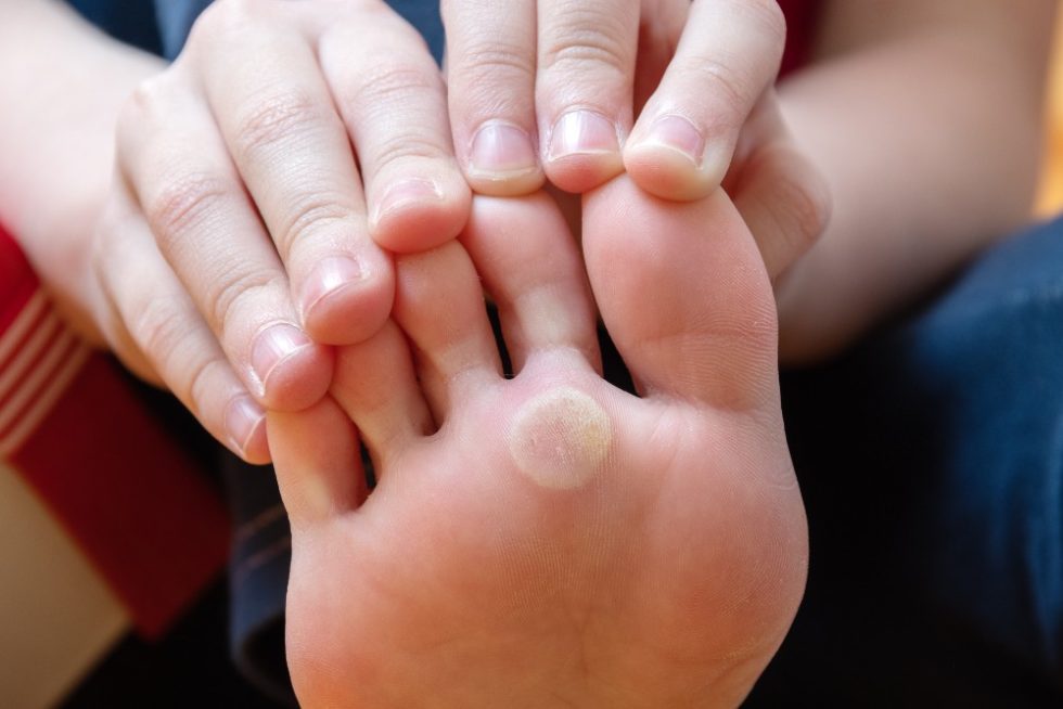 How to Treat Plantar Warts // Midwest Podiatry Centers