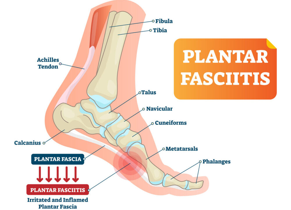 Plantar Fasciitis Treatments || Midwest Podiatry Centers
