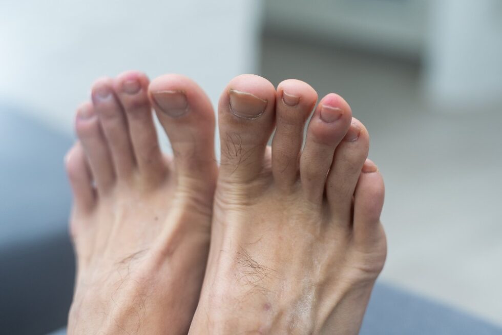 How Can I Treat My Fungal Toenails? // Midwest Podiatry Centers