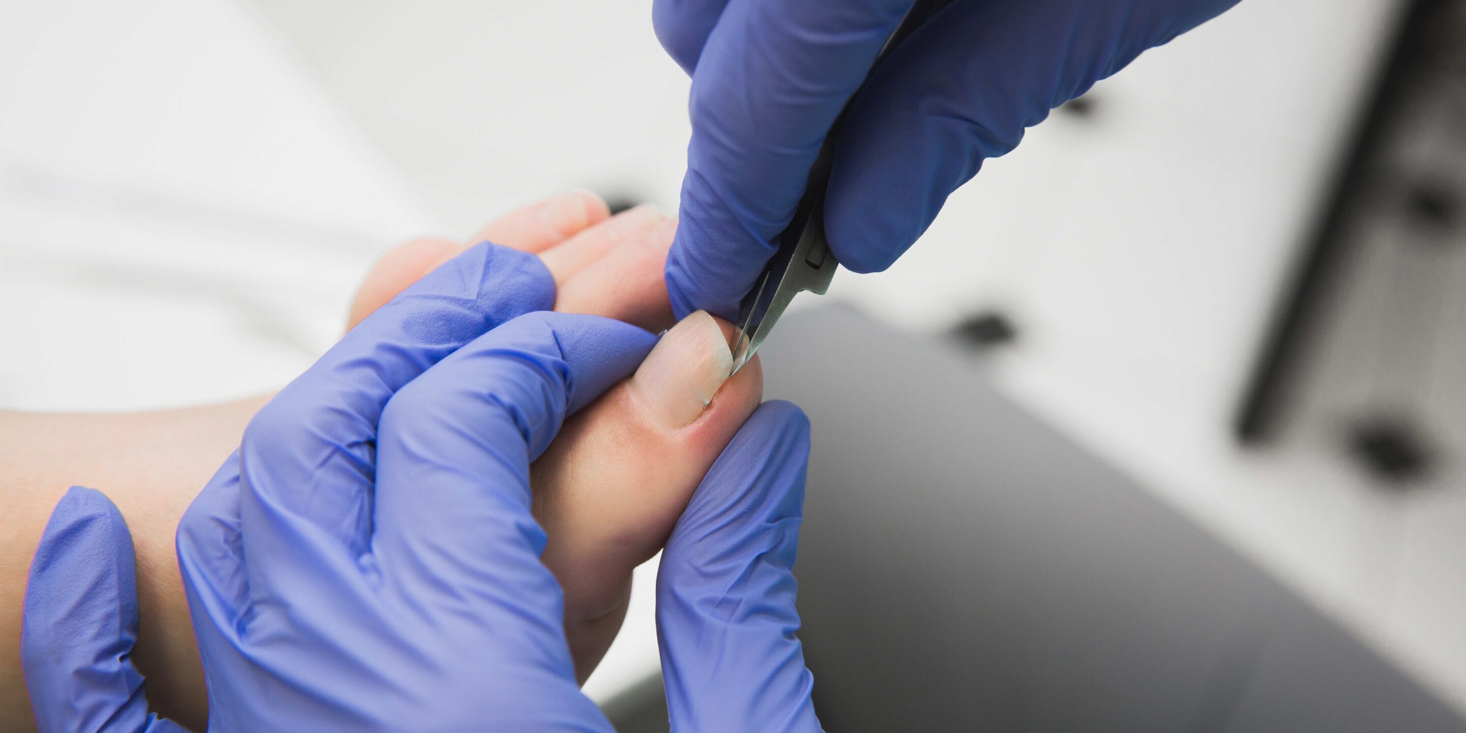 Ingrown Toenail Treatment | Midwest Podiatry Centers