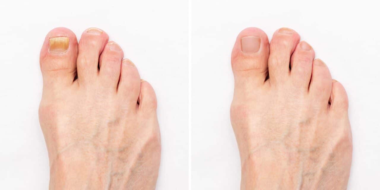 How to Know if Your Toenail Fungus is Healing? // Midwest Podiatry Centers