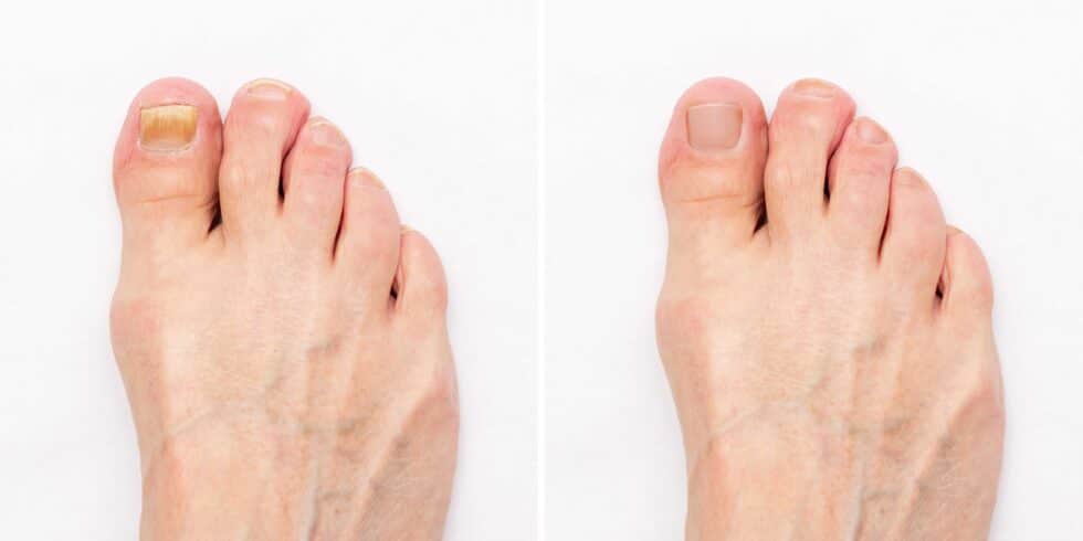 How to Know if Your Toenail Fungus is Healing? // Midwest Podiatry Centers