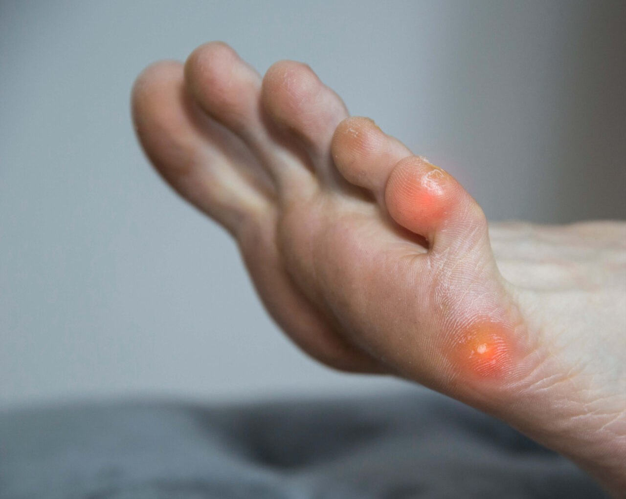 Are Plantar Warts Contagious? // Midwest Podiatry Centers